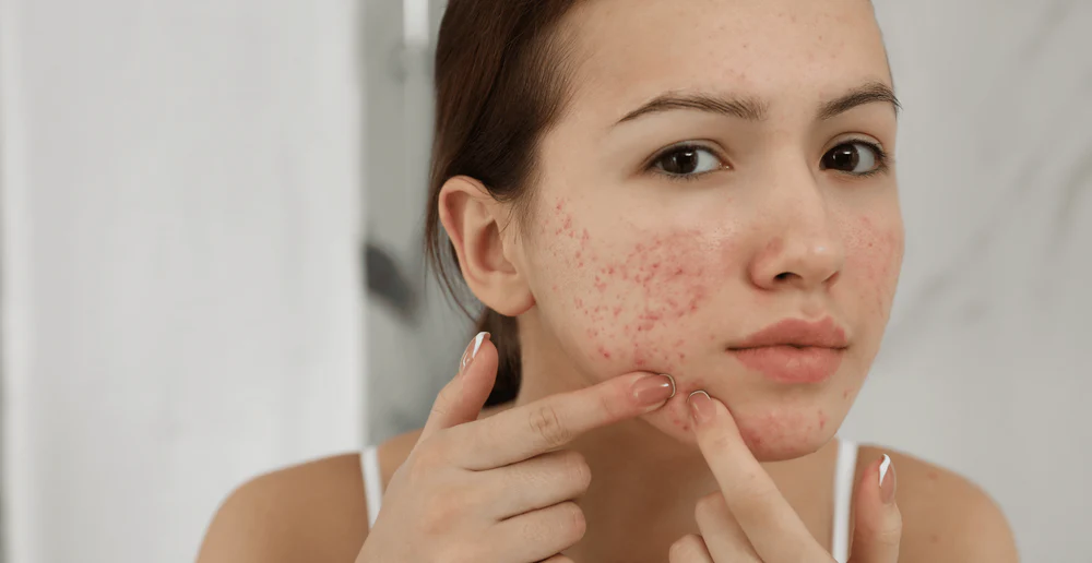 Duo Guide: What to Do If Your Skin Purges – DuoGen